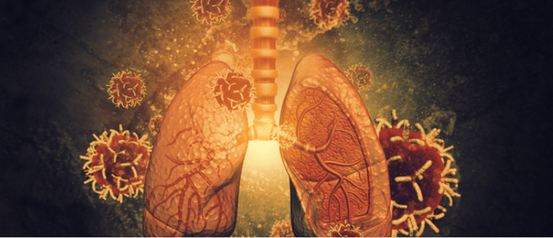 Targeted lung cancer screening program for the UK announced - Oncology ...