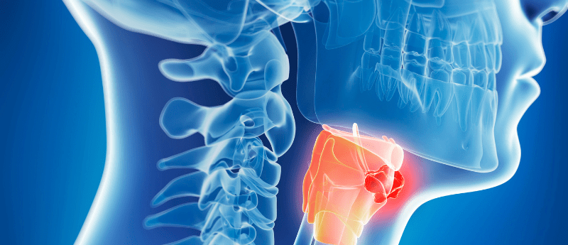 ASCO 2024: HPV vaccine reduces head and neck cancer risk in men ...