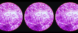 Monoclonal antibody coupled with PET-CT scan accurately spots ...
